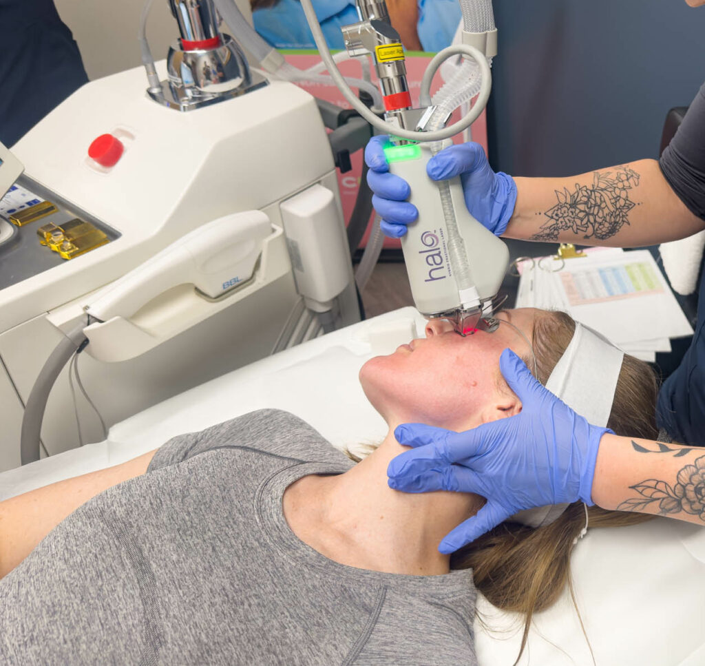 Laser Resurfacing Device in San Antonio | Halo | Marcos Medical