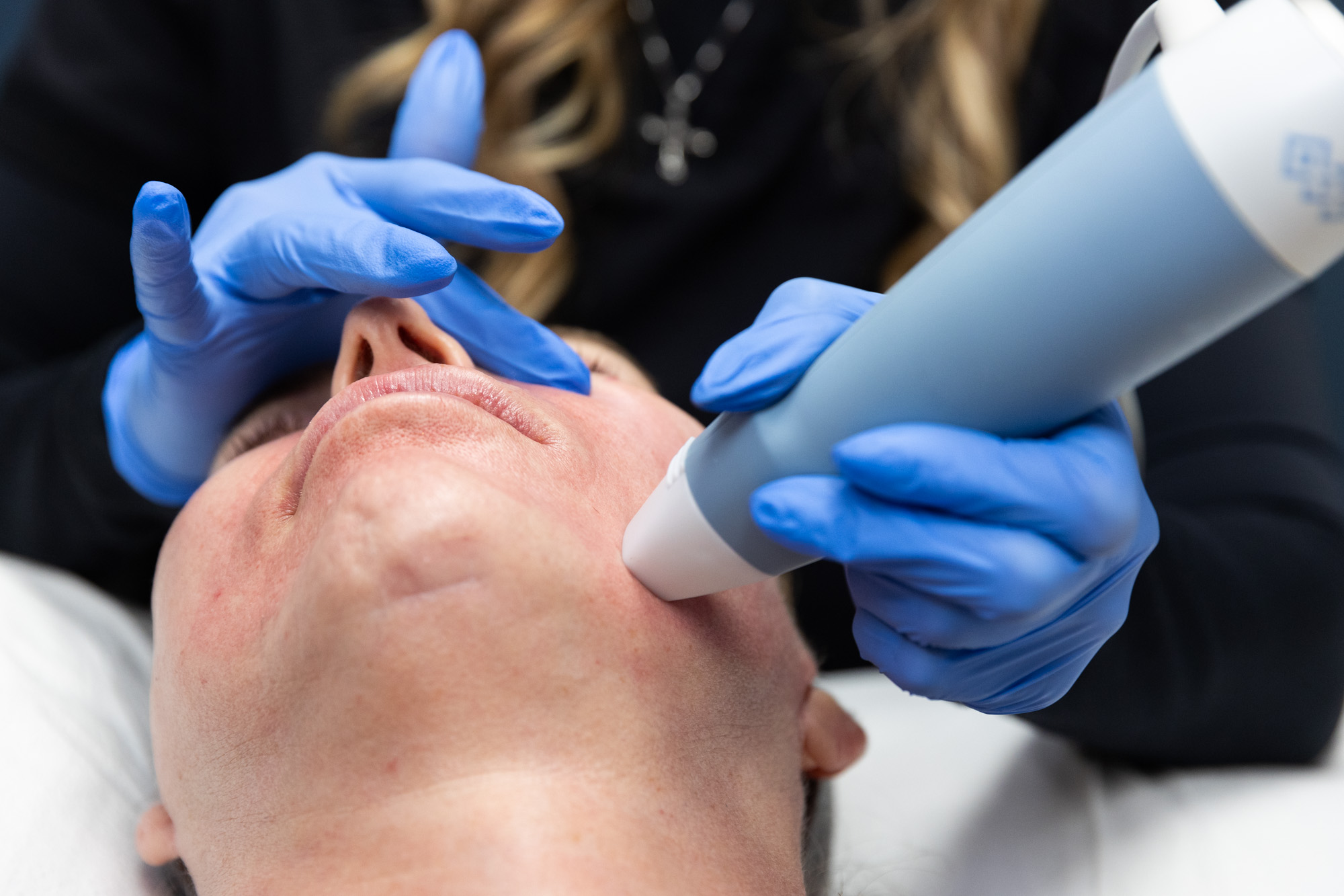 Skin Tightening in San Antonio | Exion Fractional RF Microneedling